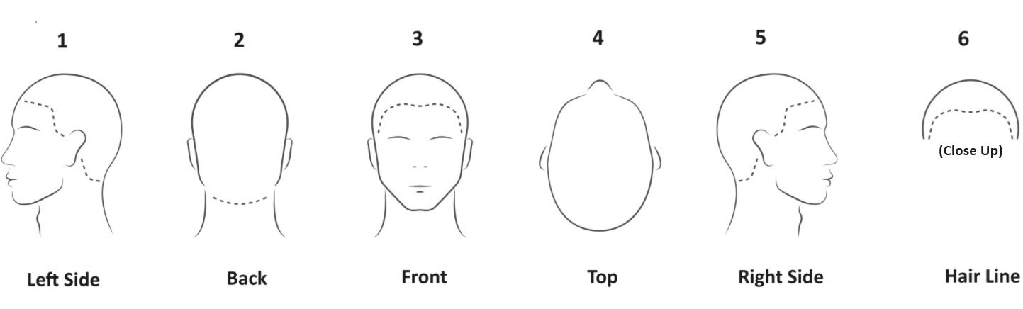 Patient Progress Photos | ReGrow Hair Restoration